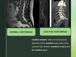 Osteomalacia 2nd-150704155942-lva1-app6892 [autosaved] | PPT