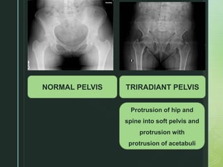 Triradiate Pelvis Osteomalacia