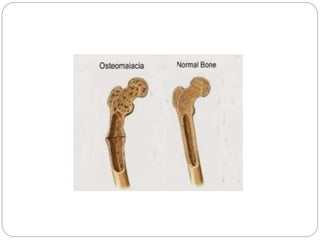 OSTEOMALACIA Basics , pathophysiology and treatment | PPTX