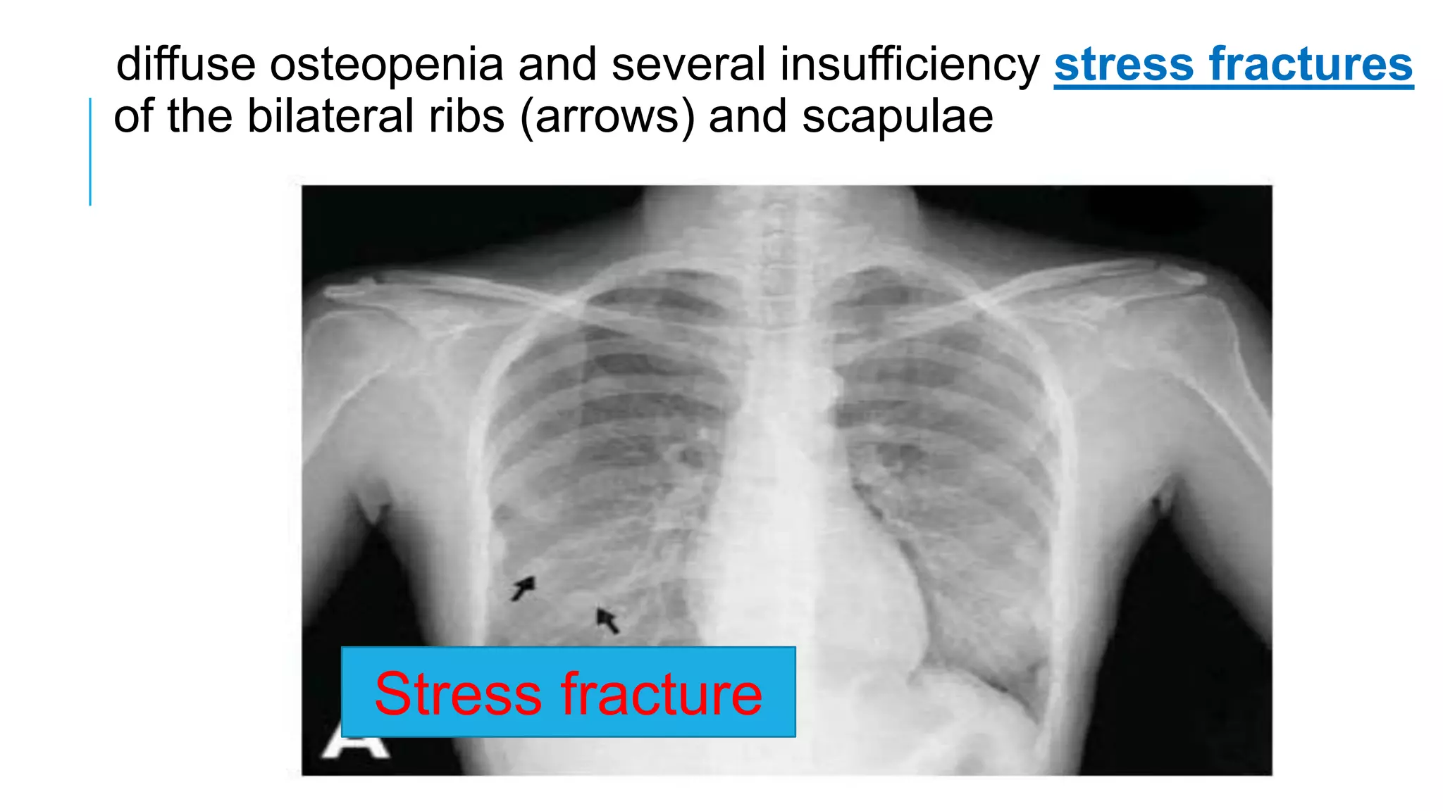 Osteomalacia and rickets | PPTX