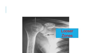 Osteomalacia and rickets | PPTX