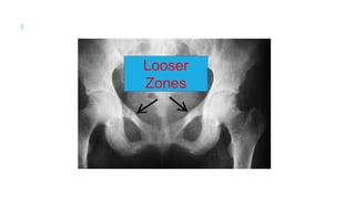 Osteomalacia and rickets | PPTX