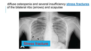 Osteomalacia and rickets | PPTX