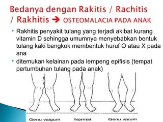 Osteomalacia dewasa shb | PPT