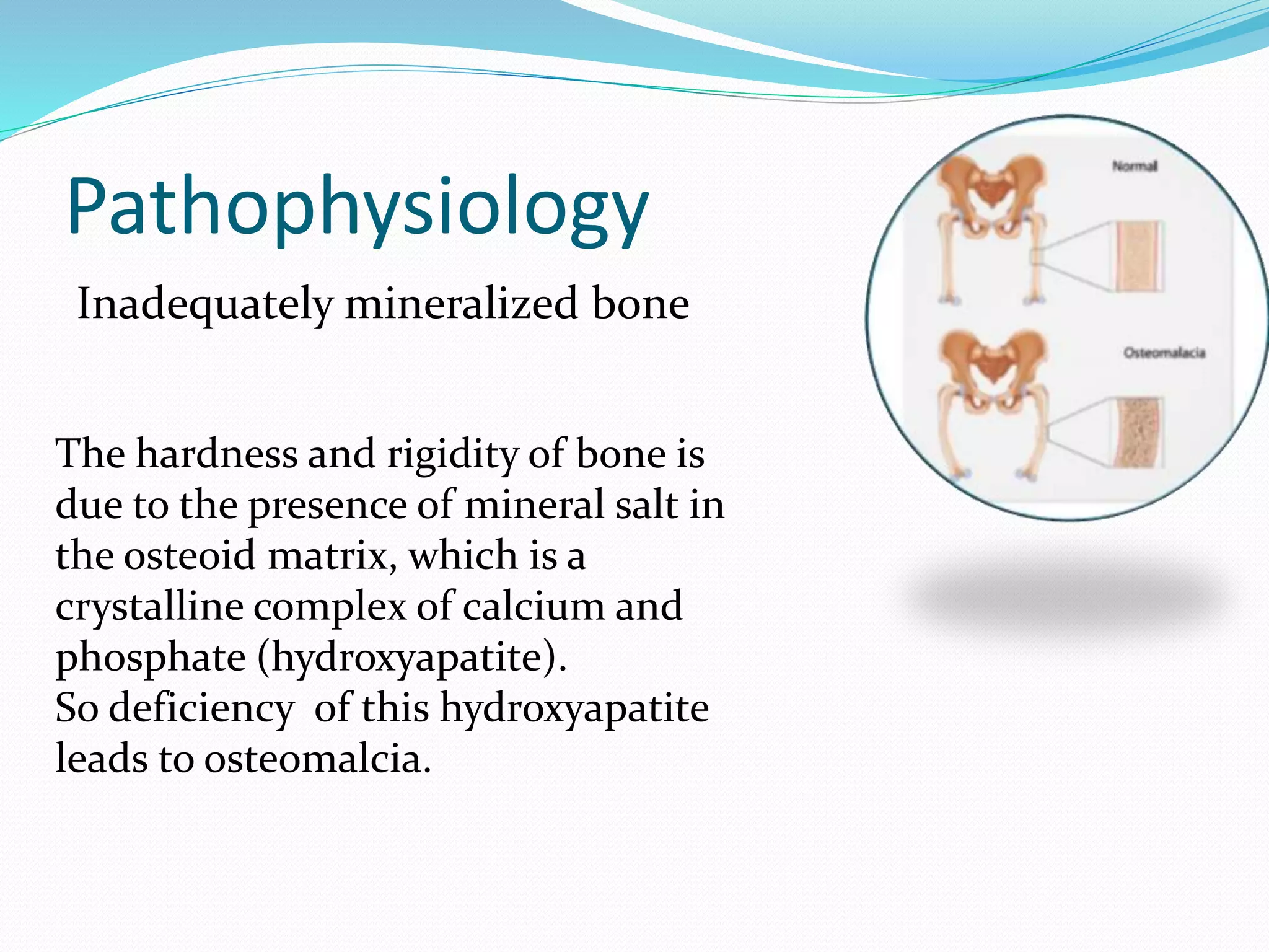 Osteomalacia new org | PPTX