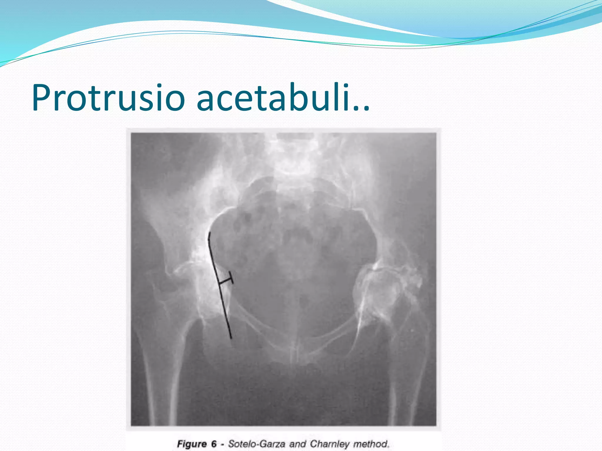 Osteomalacia new org | PPTX