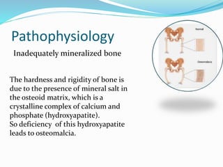 Osteomalacia new org | PPTX