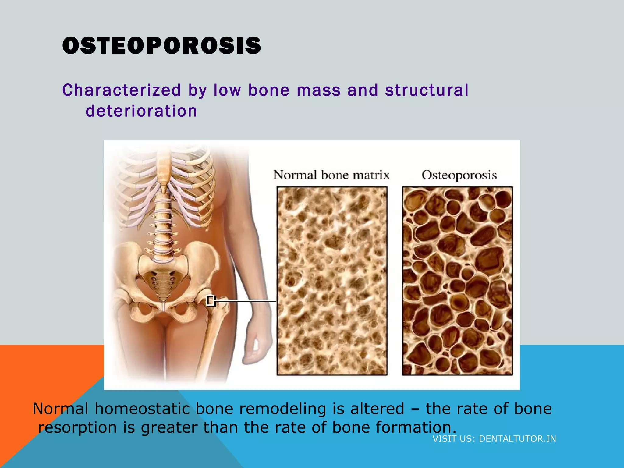 Osteomalacia osteoporosis | PPT