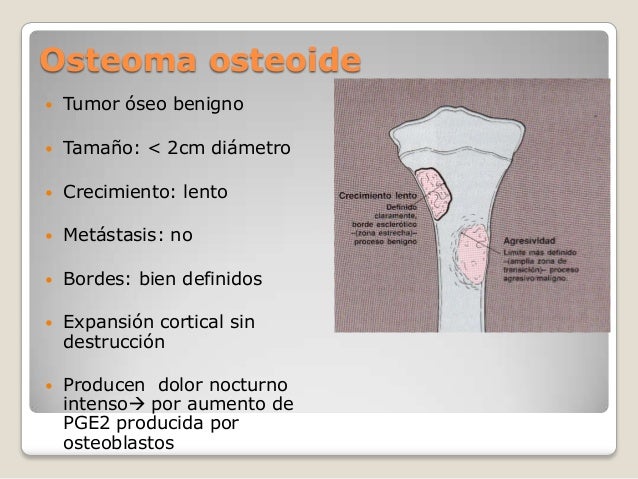 Osteoma osteoide