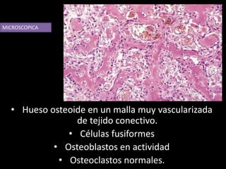 Osteoma osteoide | PPTX