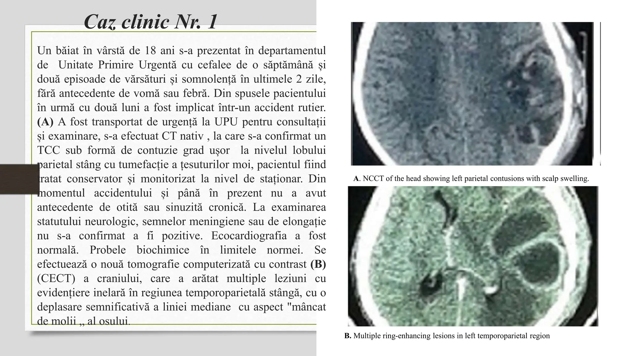 OSTEOMIELITA OASELOR CEREBRALE CU ABCES CEREBRAL.pptx