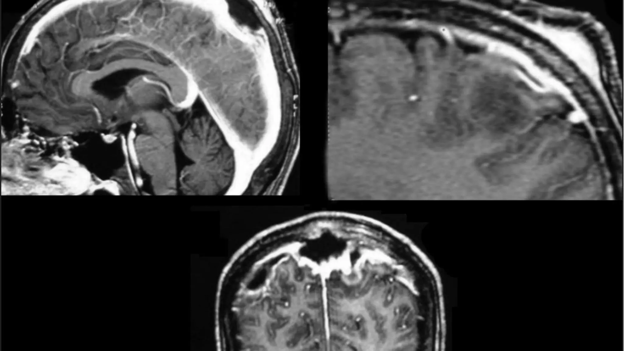 OSTEOMIELITA OASELOR CEREBRALE CU ABCES CEREBRAL.pptx