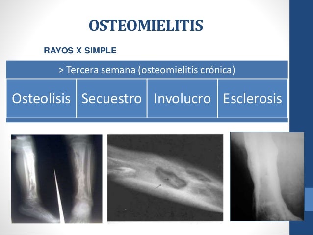 Rayosxdeosteomielitis