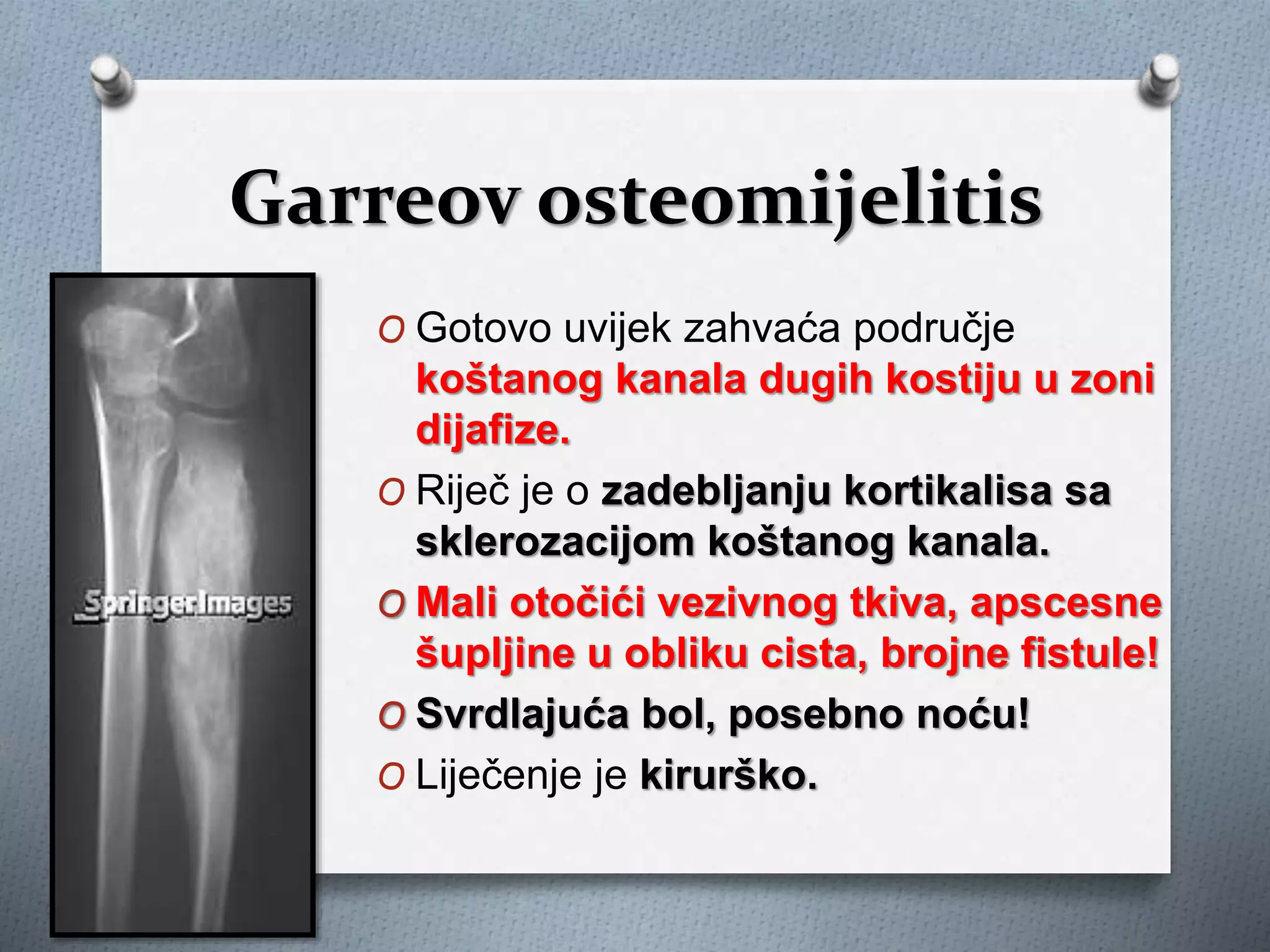 Osteomijelitis | PPSX
