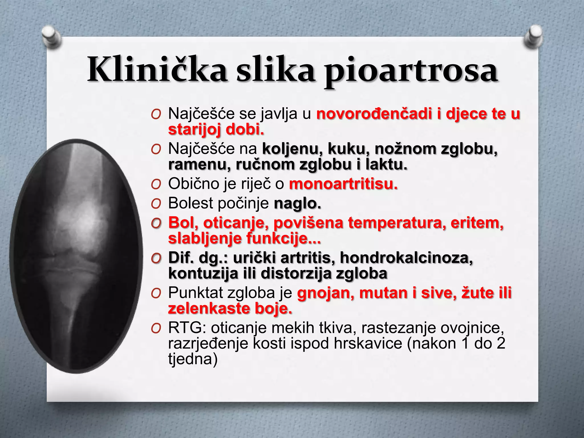 Osteomijelitis | PPSX