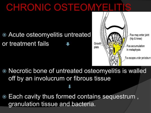 Osteomyelitis | PPT
