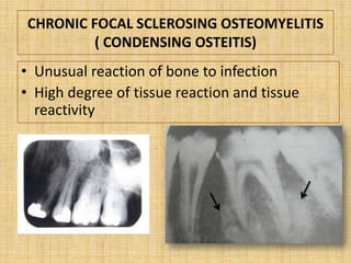 Focal Sclerosing Osteomyelitis