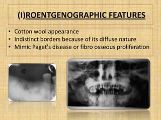Diffuse Sclerosing Osteomyelitis