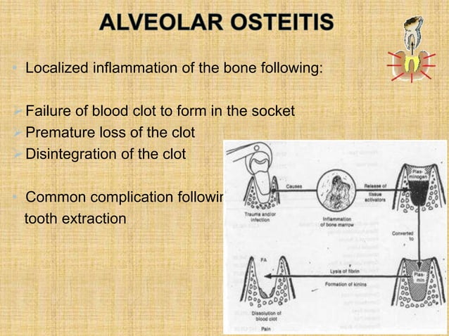 Osteomyelitis | PPTX | Dental Health | Diseases and Conditions