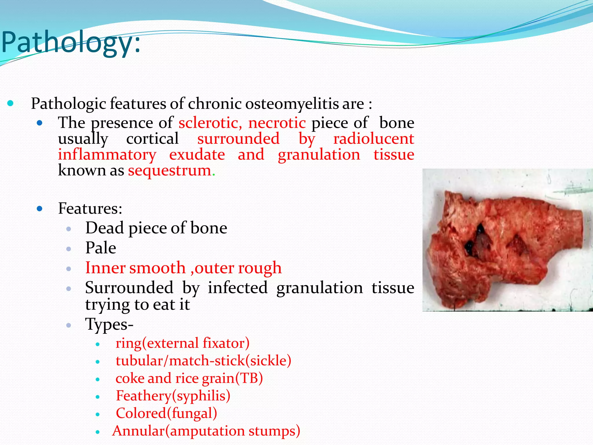 Osteomyelitis | PPTX