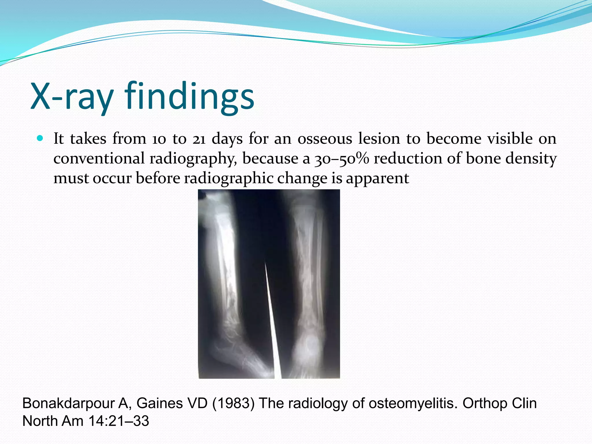Osteomyelitis | PPTX
