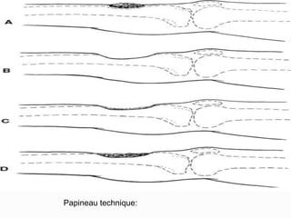Osteomyelitis | PPTX