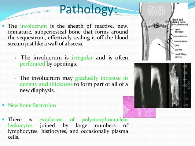 Osteomyelitis