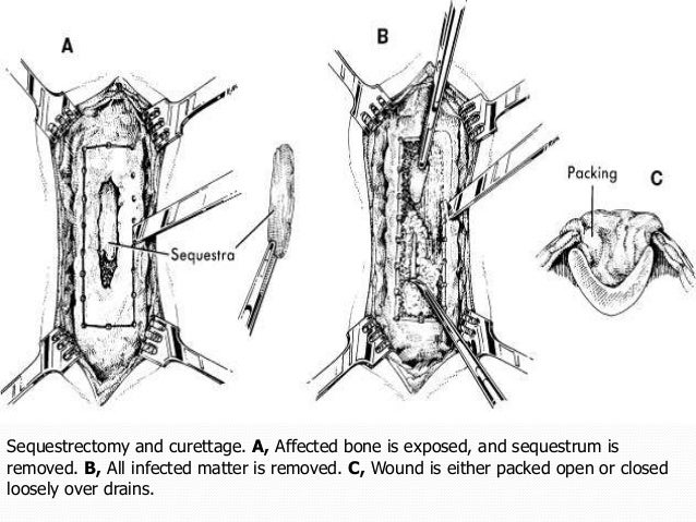 Osteomyelitis