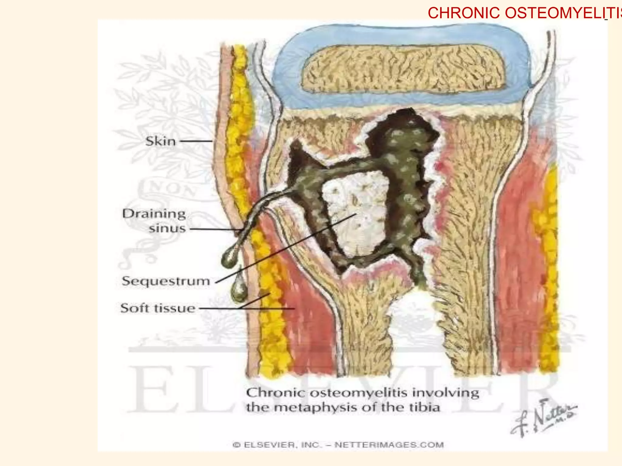Osteomyelitis | PPTX
