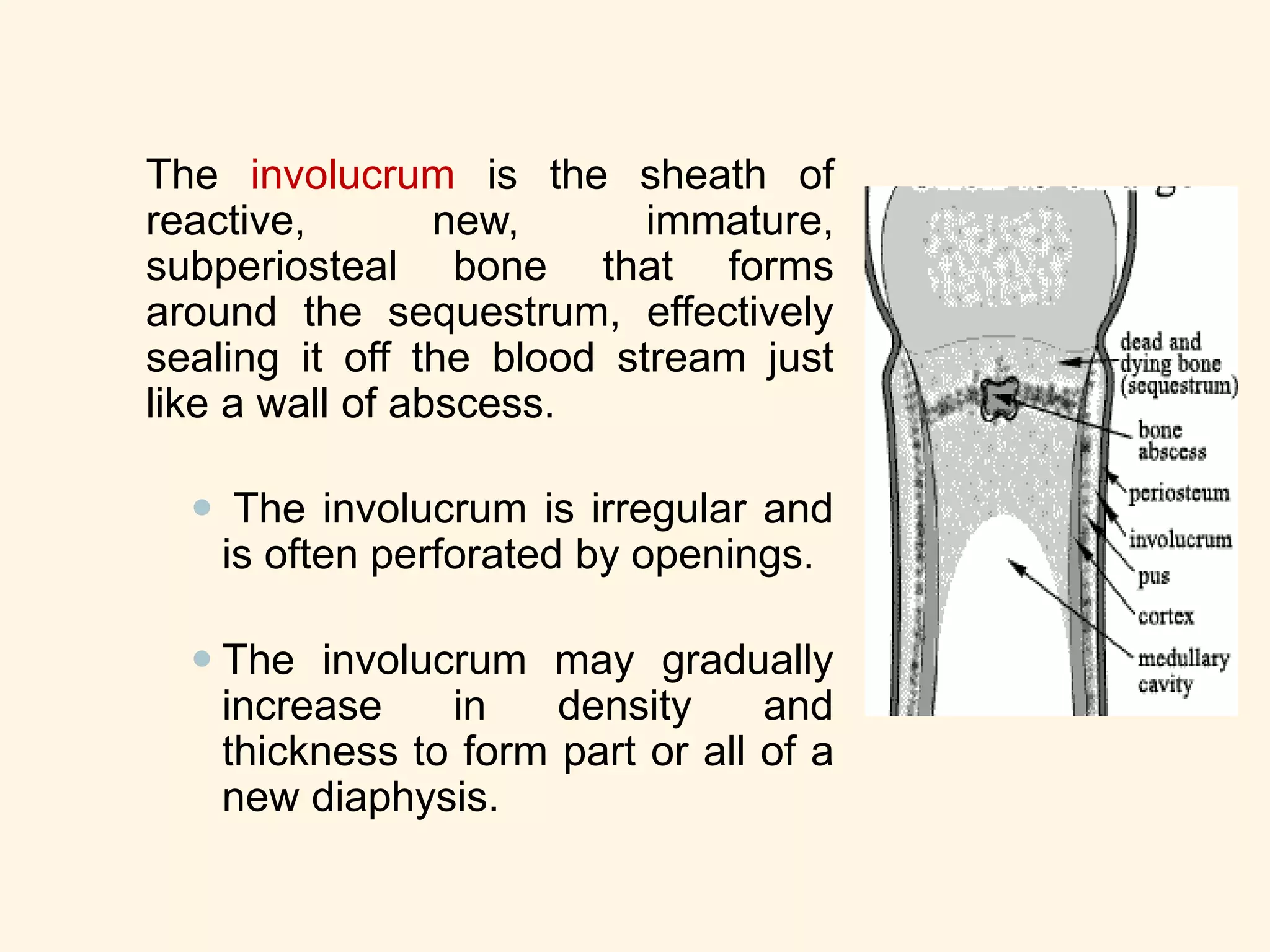 Osteomyelitis | PPTX