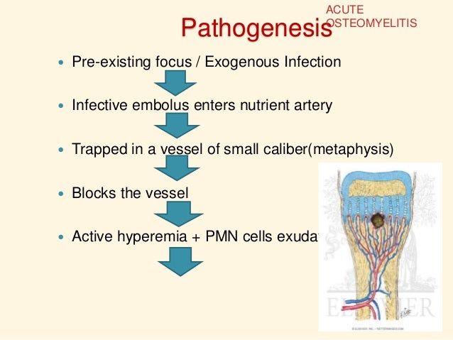 Osteomyelitis