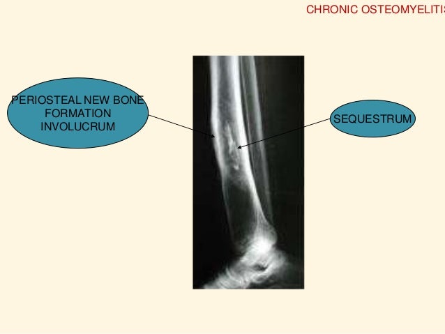 Osteomyelitis