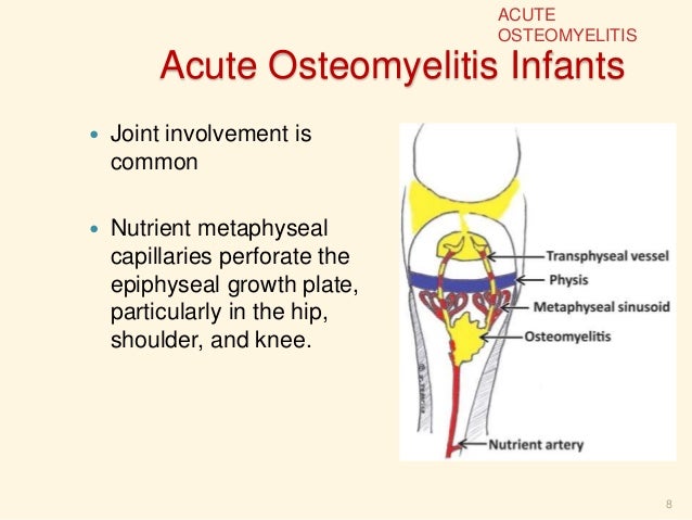 Osteomyelitis