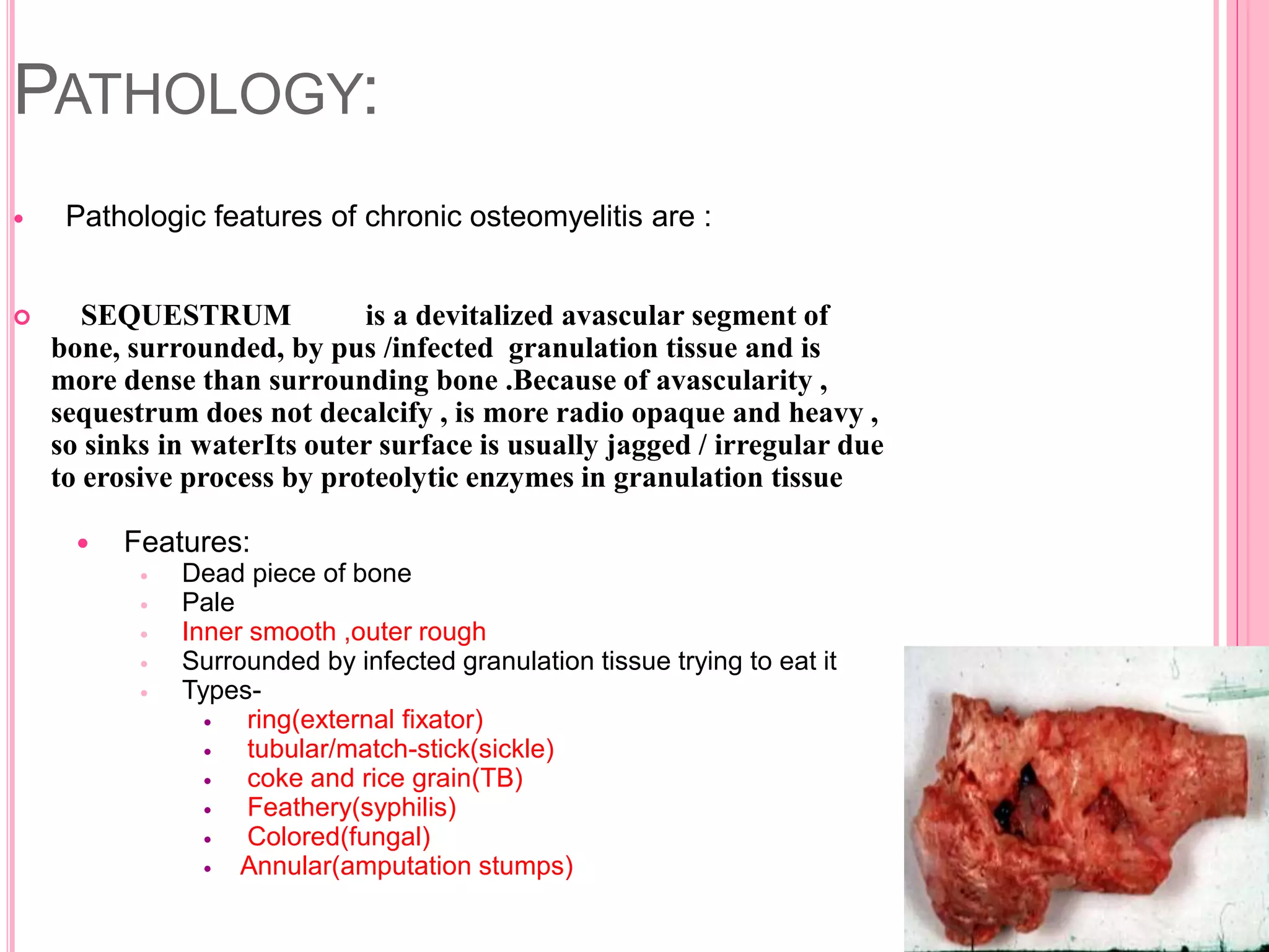 Osteomyelitis | PPTX
