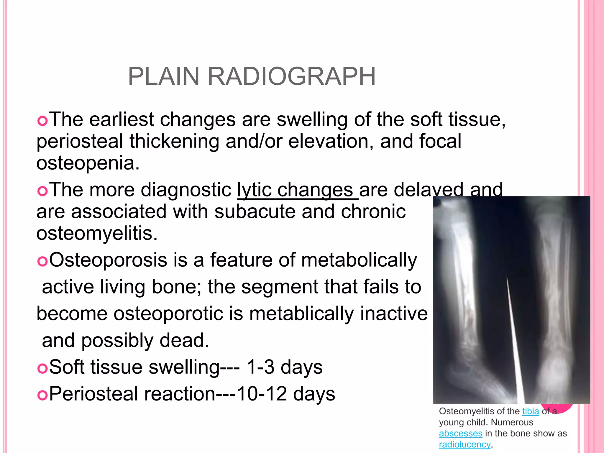 Osteomyelitis | PPTX