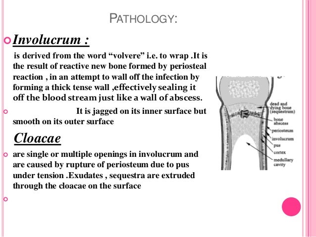 Osteomyelitis