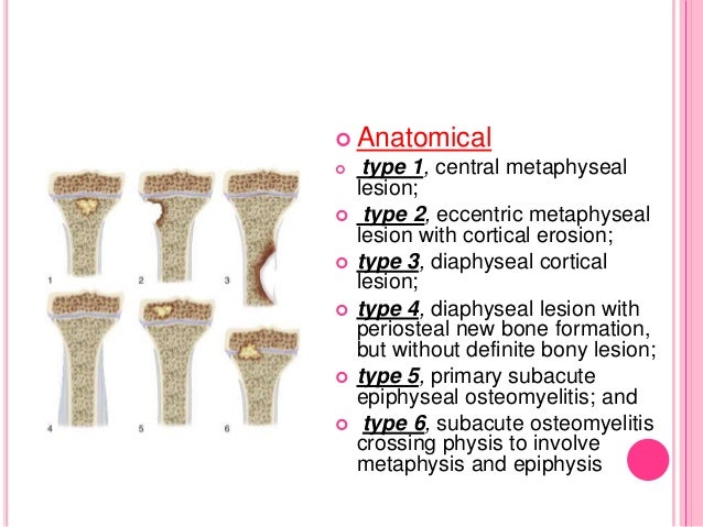 Osteomyelitis