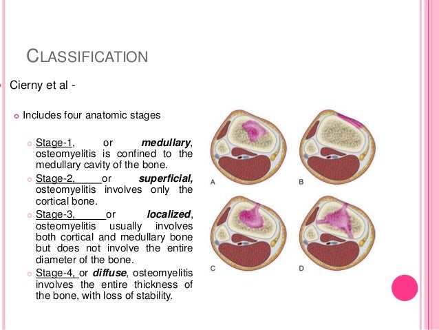 Osteomyelitis