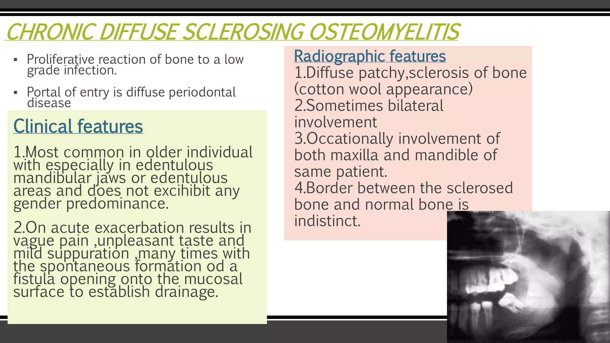 Osteomyelitis | PPTX