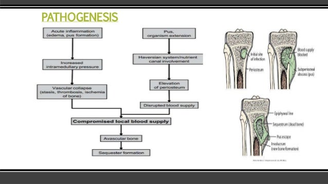 Osteomyelitis