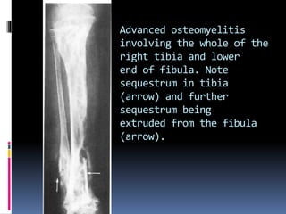 Osteomyelitis | PPTX