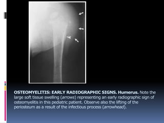 Osteomyelitis | PPTX
