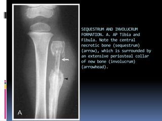 Osteomyelitis | PPTX