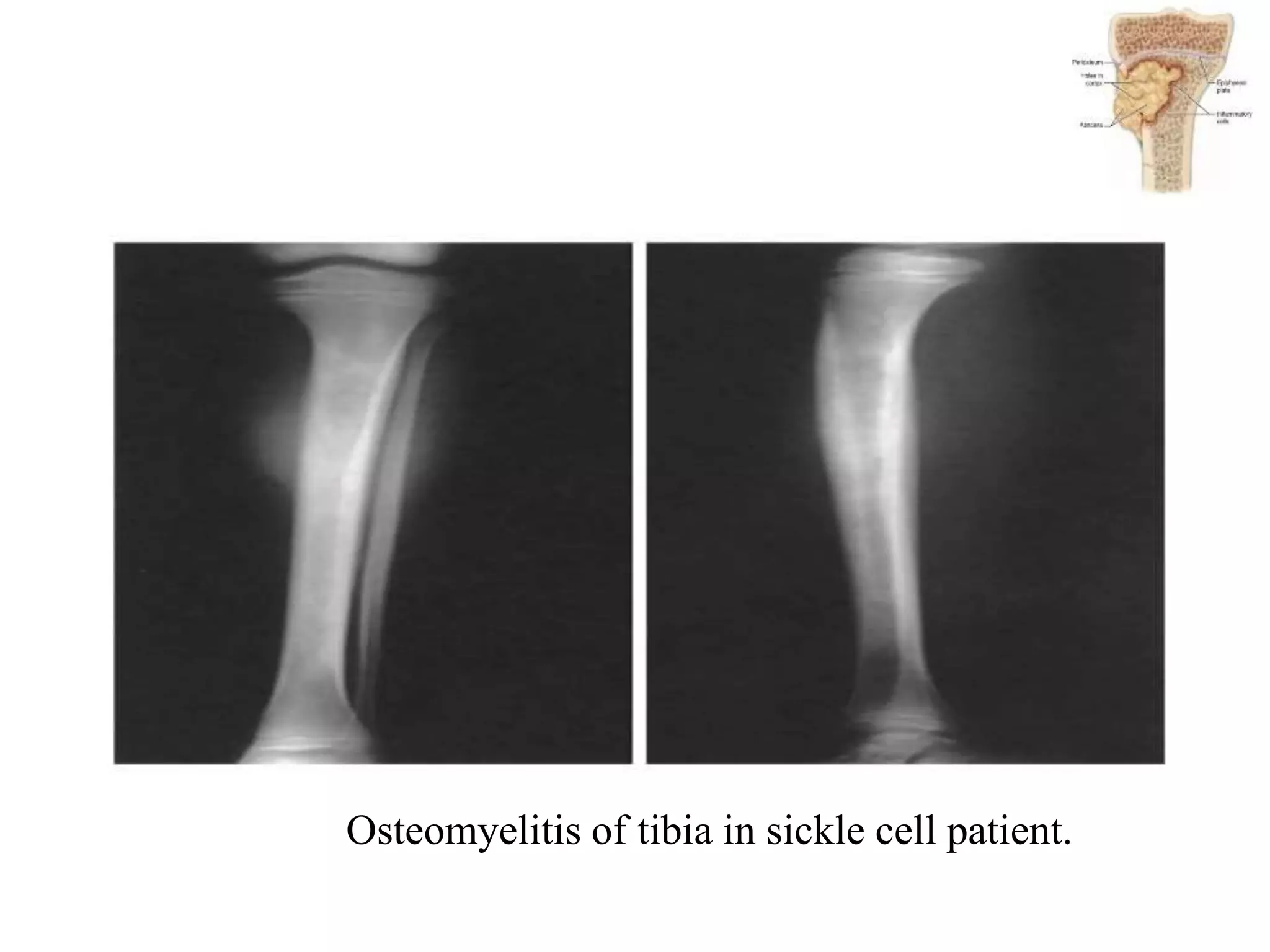 Osteomyelitis | PPTX