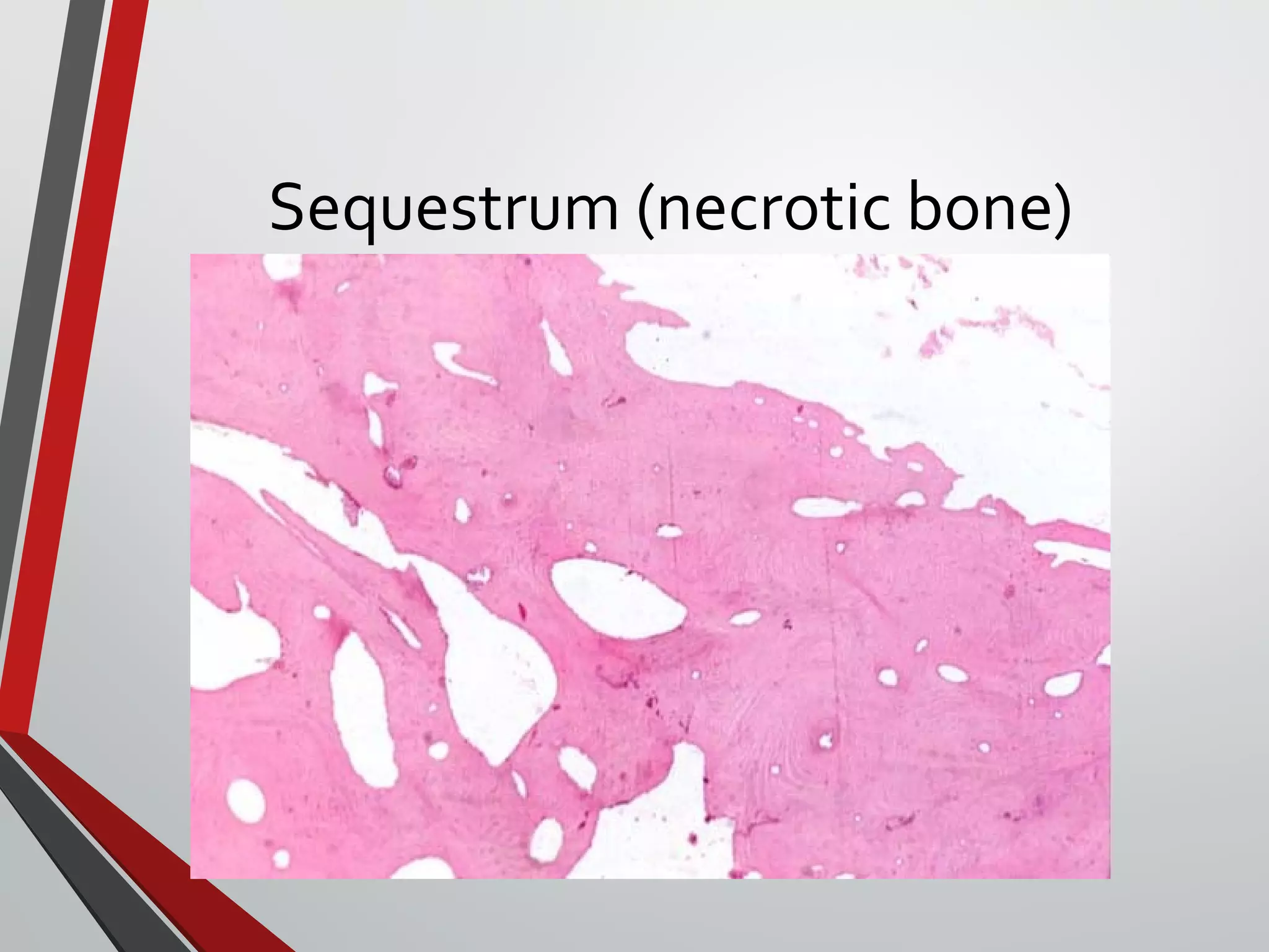 Osteomyelitis | PPT