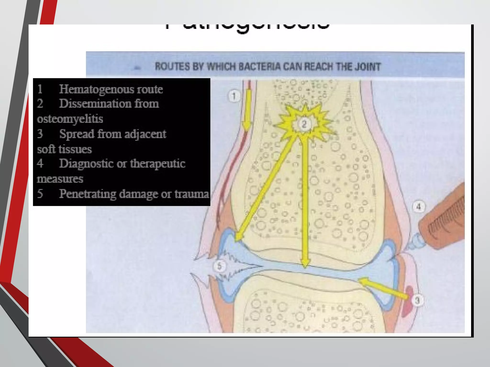 Osteomyelitis | PPT