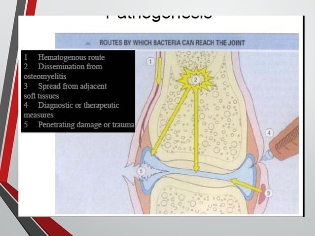 Osteomyelitis | PPT