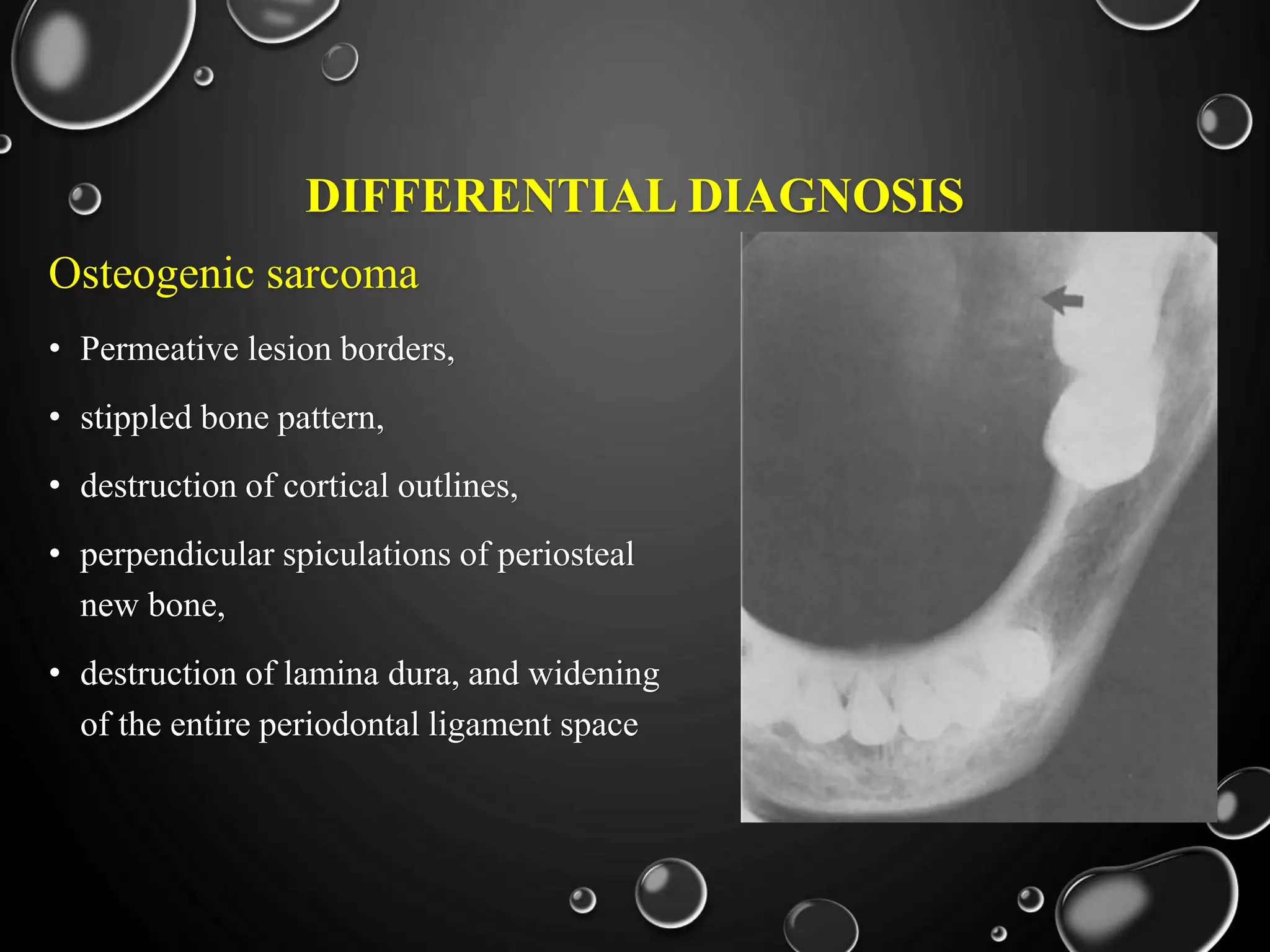 Osteomyelitis | PPTX