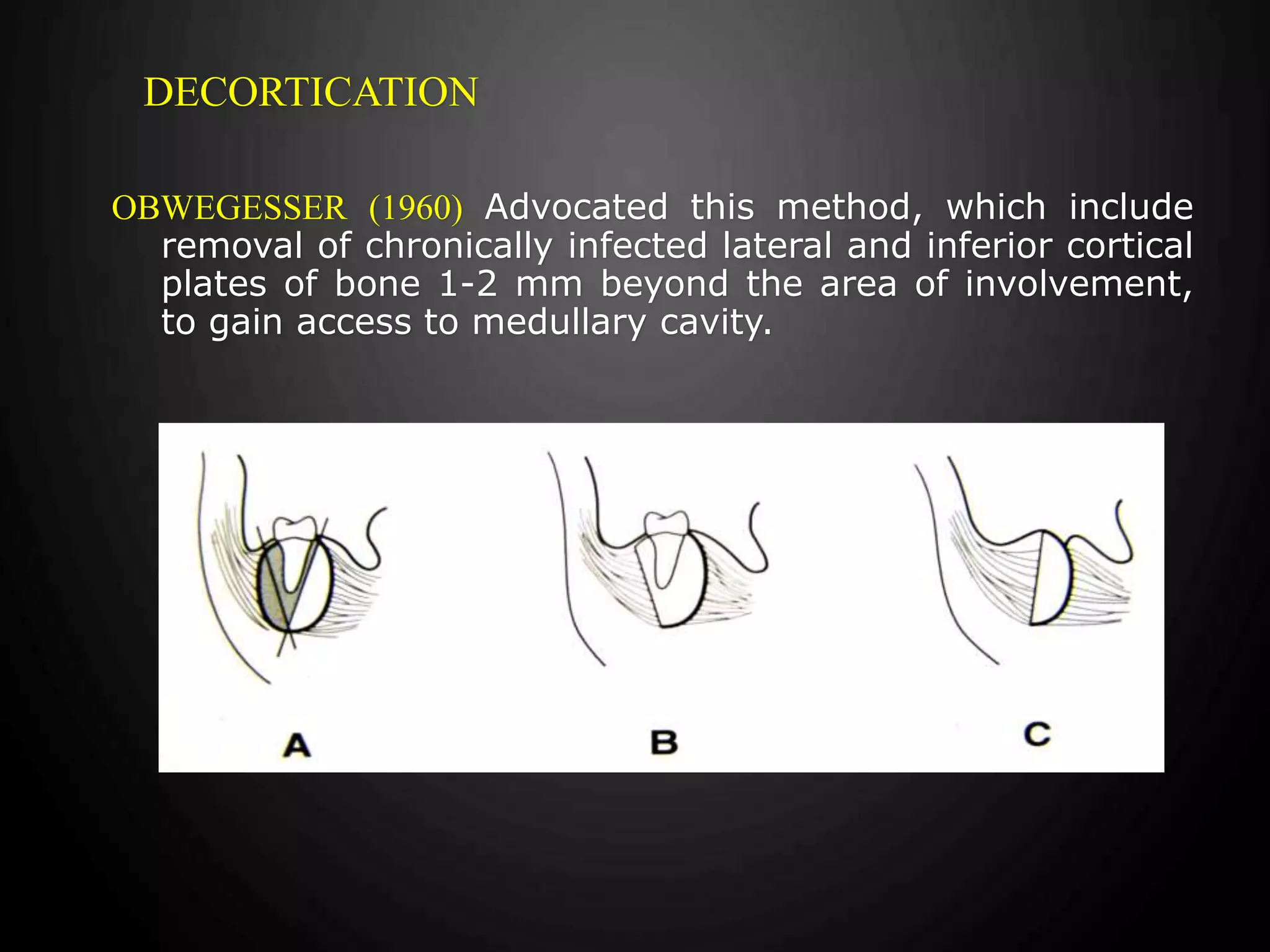 Osteomyelitis | PPTX