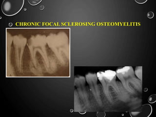Focal Sclerosing Osteomyelitis